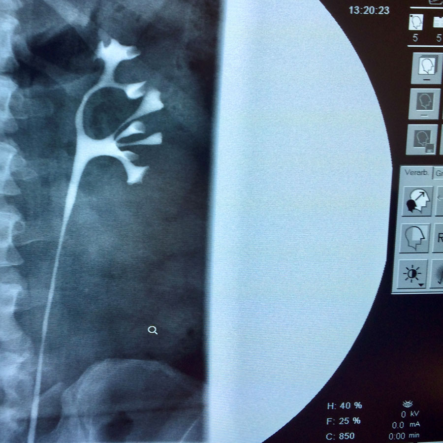 Nierensteine Die Wichtigsten Fakten